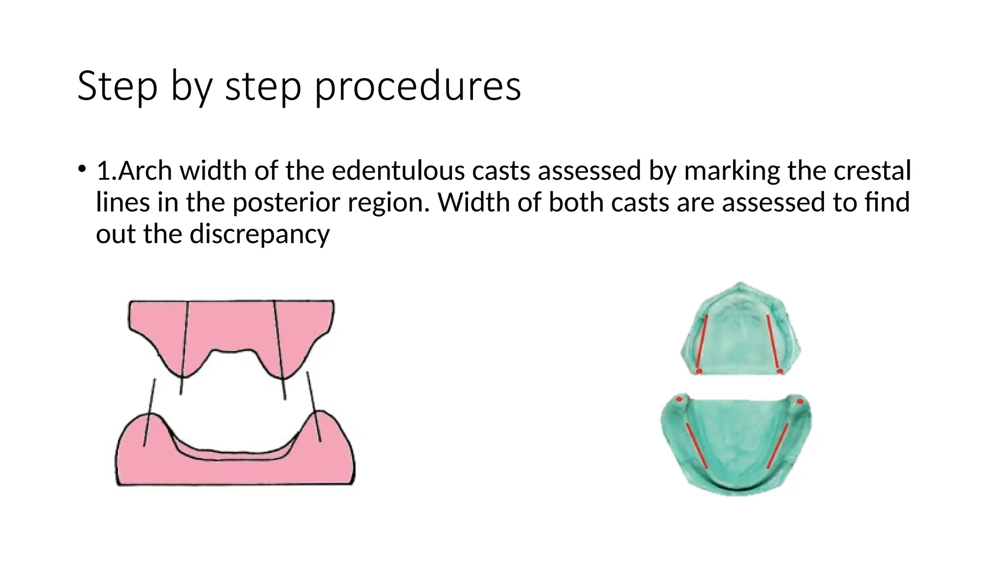 A METHOD OF CROSSBITE SETTING in class 3.pptx