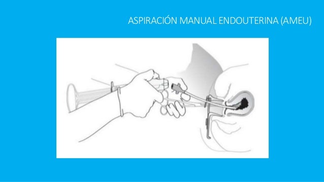 Aspiracion manual endouterina (AMEU)