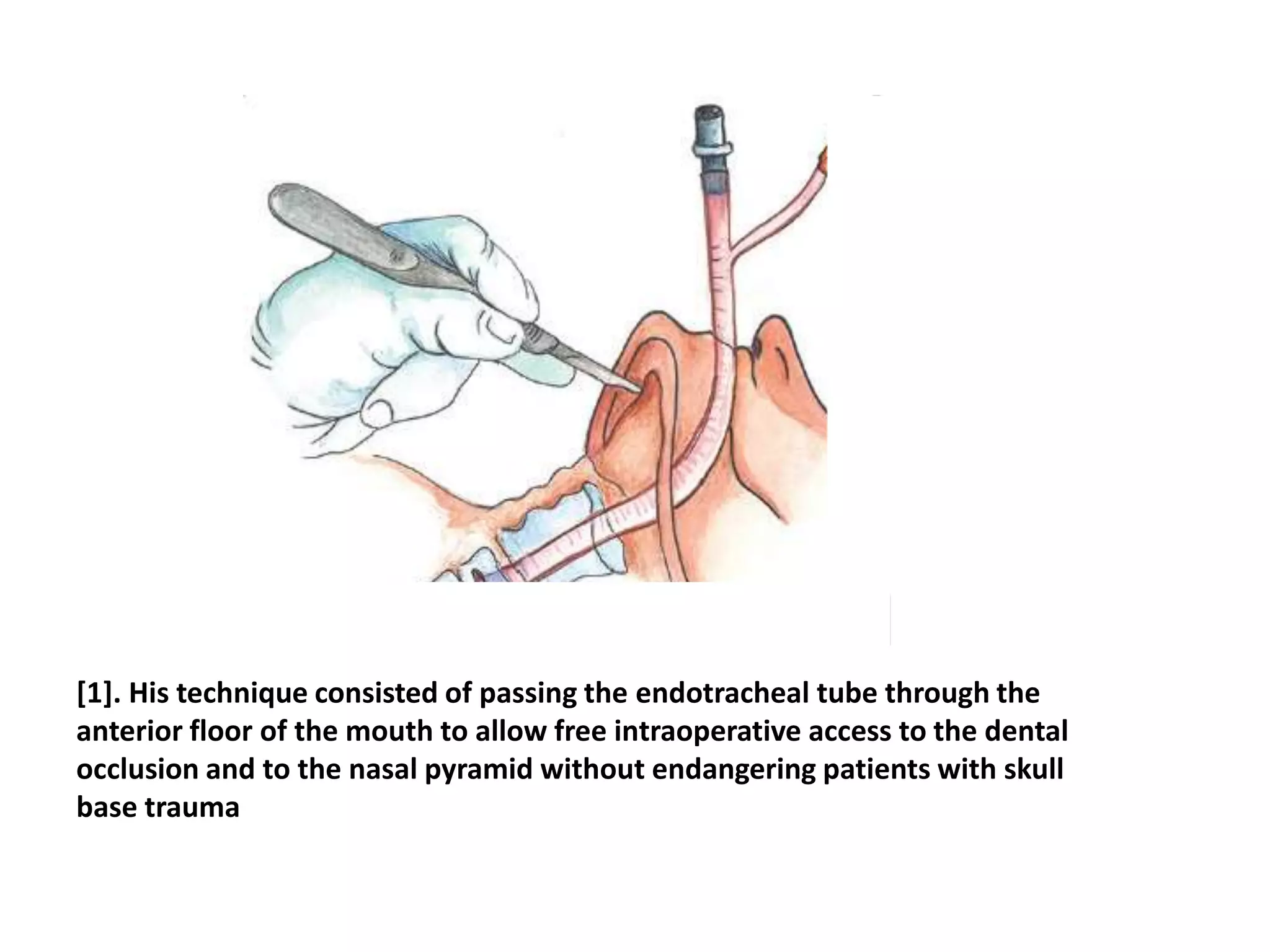 Submental Intubation - (Steps Of The Procedure Explained) | PPSX