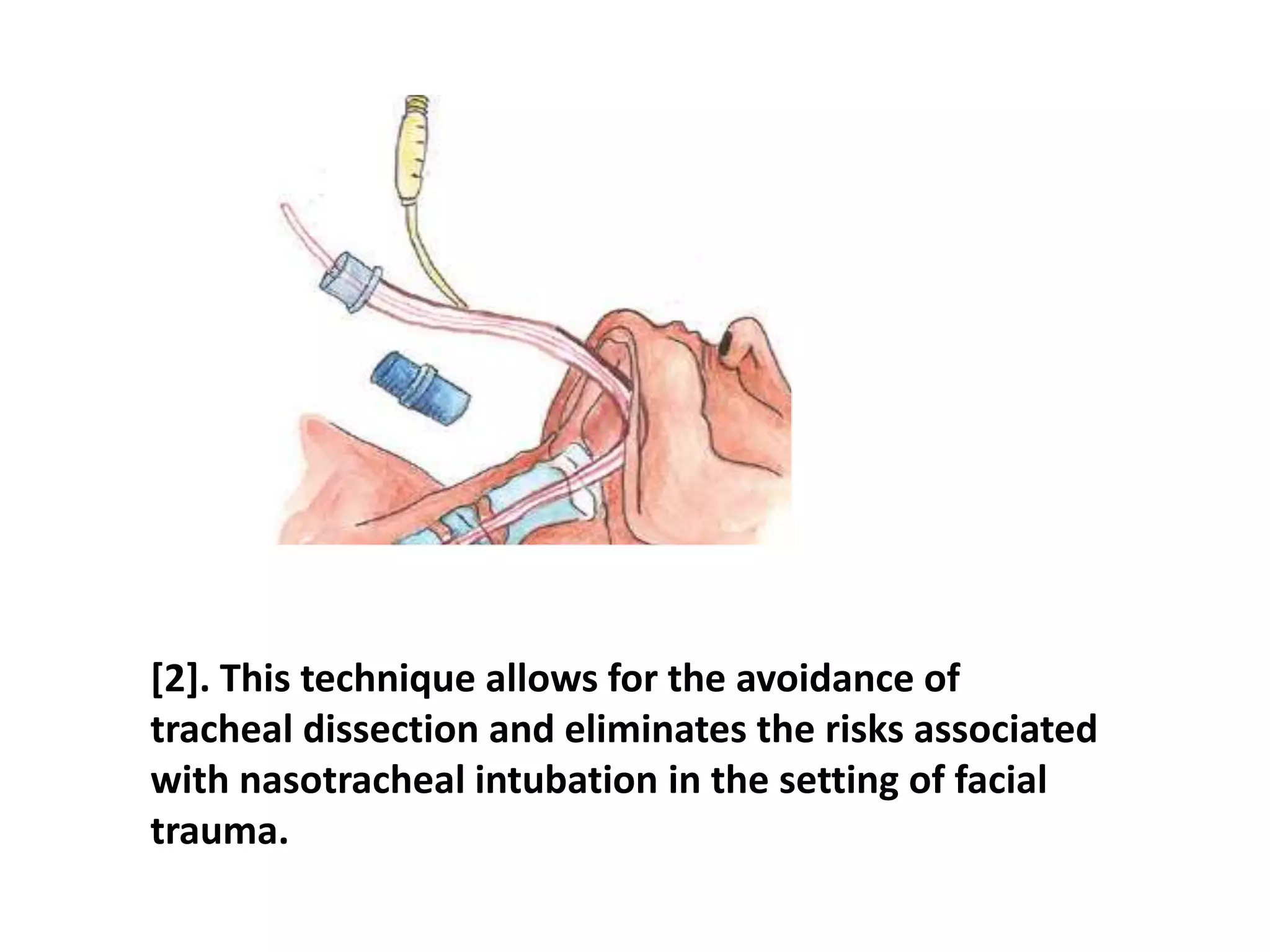 Submental Intubation - (Steps Of The Procedure Explained) | PPSX
