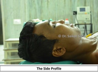 Submental Intubation - (Steps Of The Procedure Explained) | PPSX