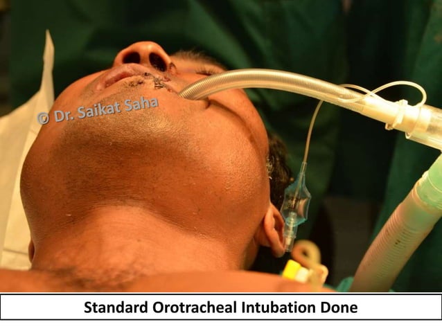 Submental Intubation - (Steps Of The Procedure Explained) | PPSX ...
