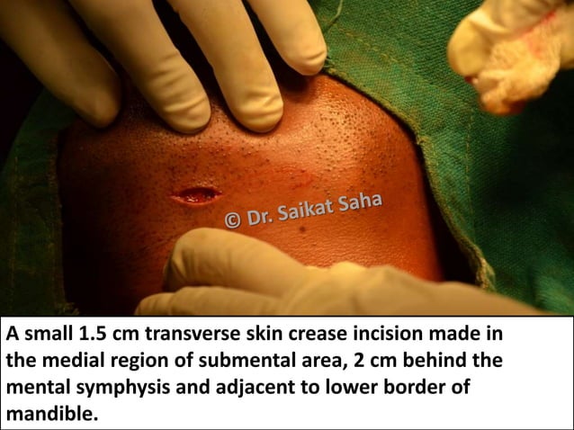 Submental Intubation - (Steps Of The Procedure Explained) | PPSX ...