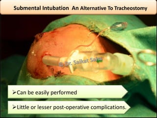 Submental Intubation - (Steps Of The Procedure Explained) | PPSX