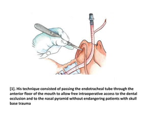 Submental Intubation - (Steps Of The Procedure Explained) | PPSX