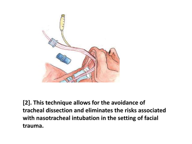 Submental Intubation - (Steps Of The Procedure Explained) | PPSX ...