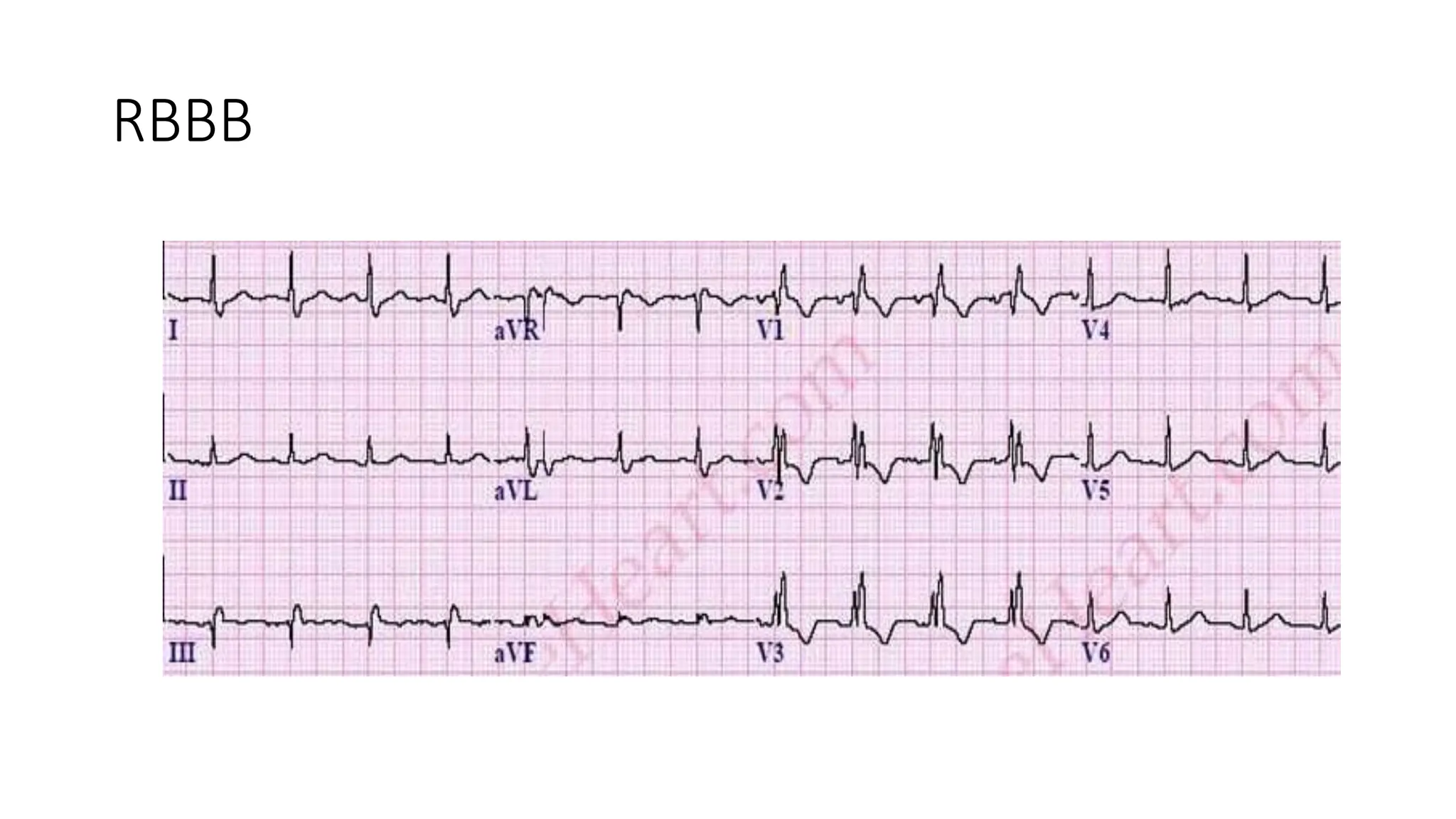 AMI DIAGNOSTICS IN CASE OF LBBB AND.pptx