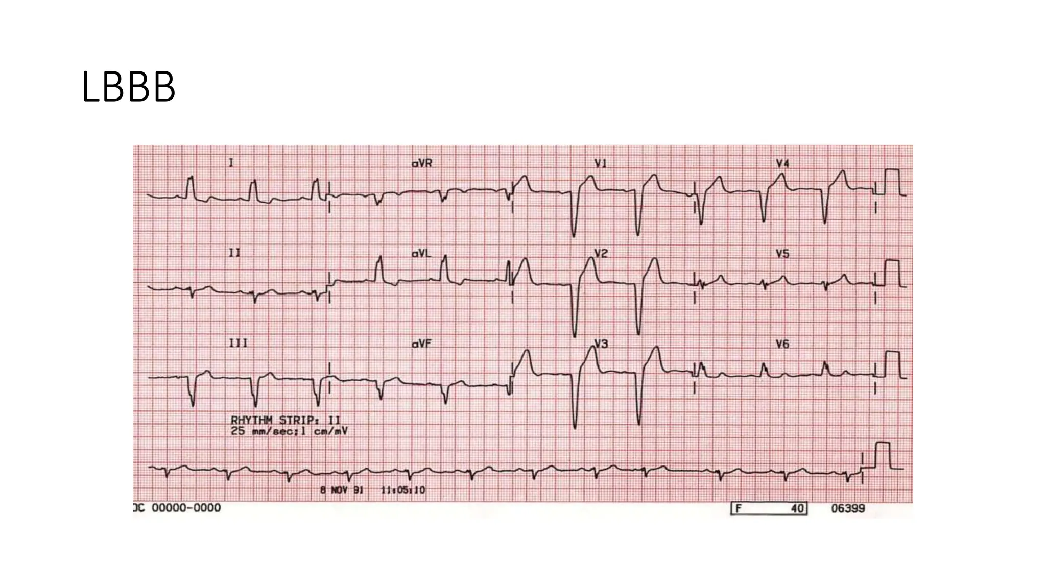 AMI DIAGNOSTICS IN CASE OF LBBB AND.pptx