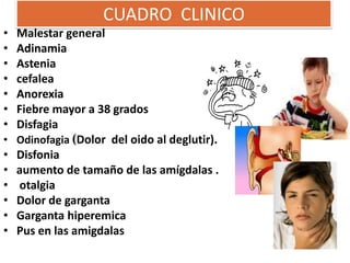 Amigdalitis | PPTX