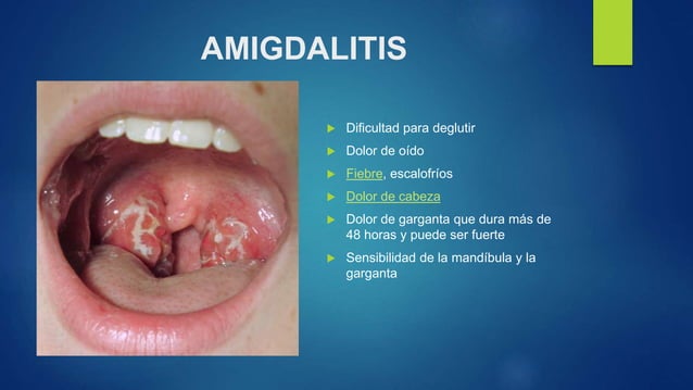 Amigdalas | PPTX