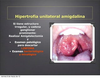Amigdalas y adenoides | PDF
