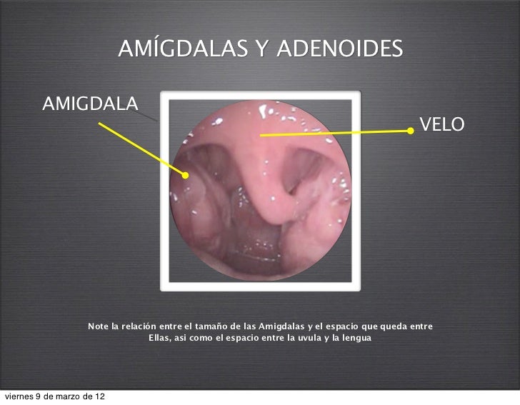Amigdalas y adenoides