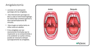 Amigdalectomía | PPTX