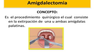 AMIGDALECTOMÍA. Enfermeria comunitaria.pdf