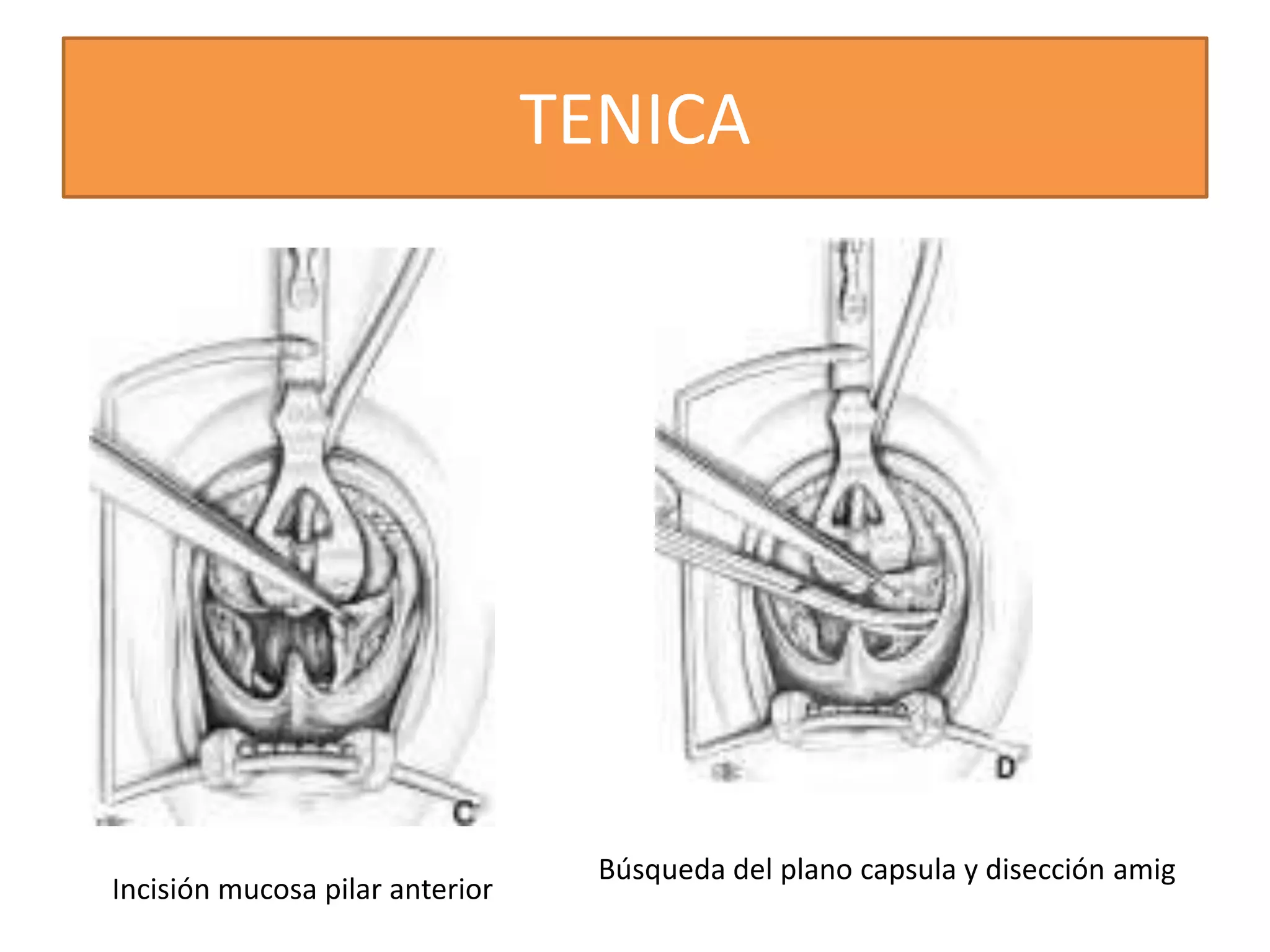 Amigdalectomia - Adenoidectomia | PPTX