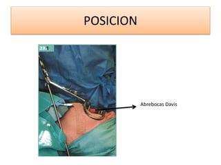 Amigdalectomia - Adenoidectomia | PPTX
