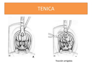 Amigdalectomia - Adenoidectomia | PPTX