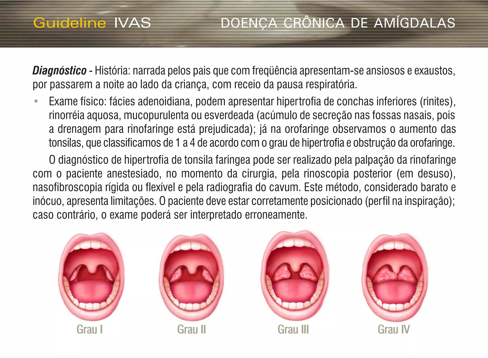 Guideline para Amigdalectomia | PDF