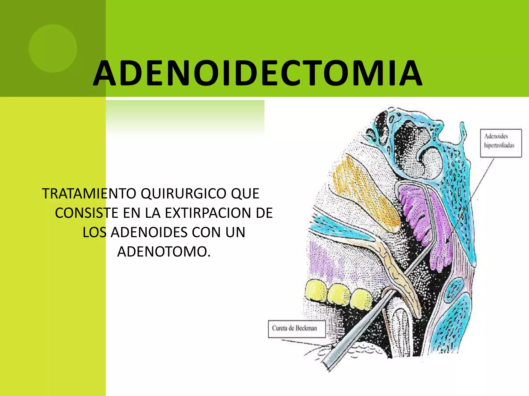 Amigdalectomia 1 | PPTX