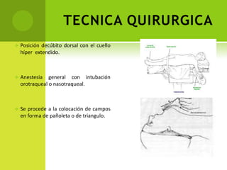 Amigdalectomia 1 | PPTX