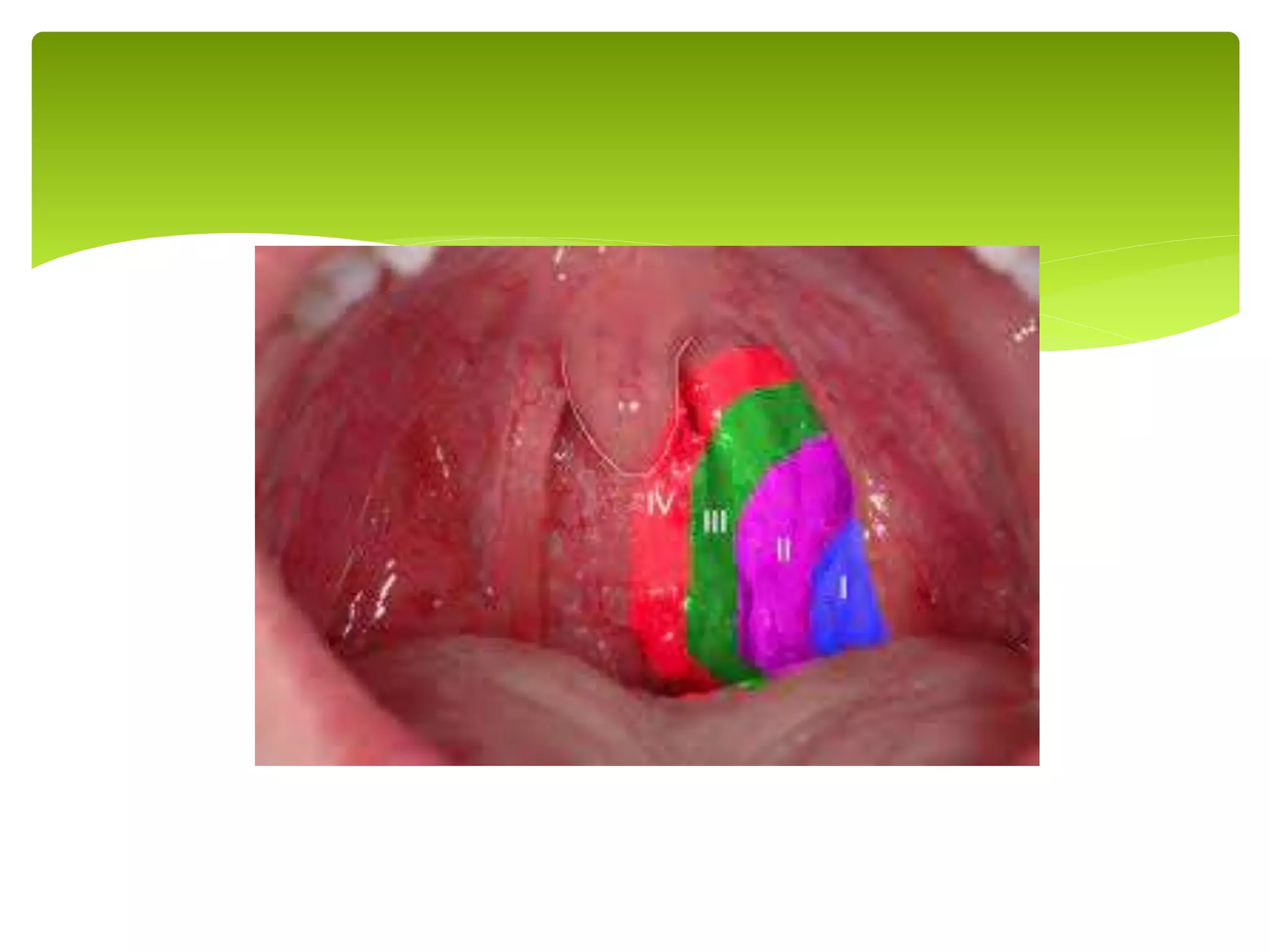 AMIGDALECTOMIA Y ADENOIDECTOMIA.pptx