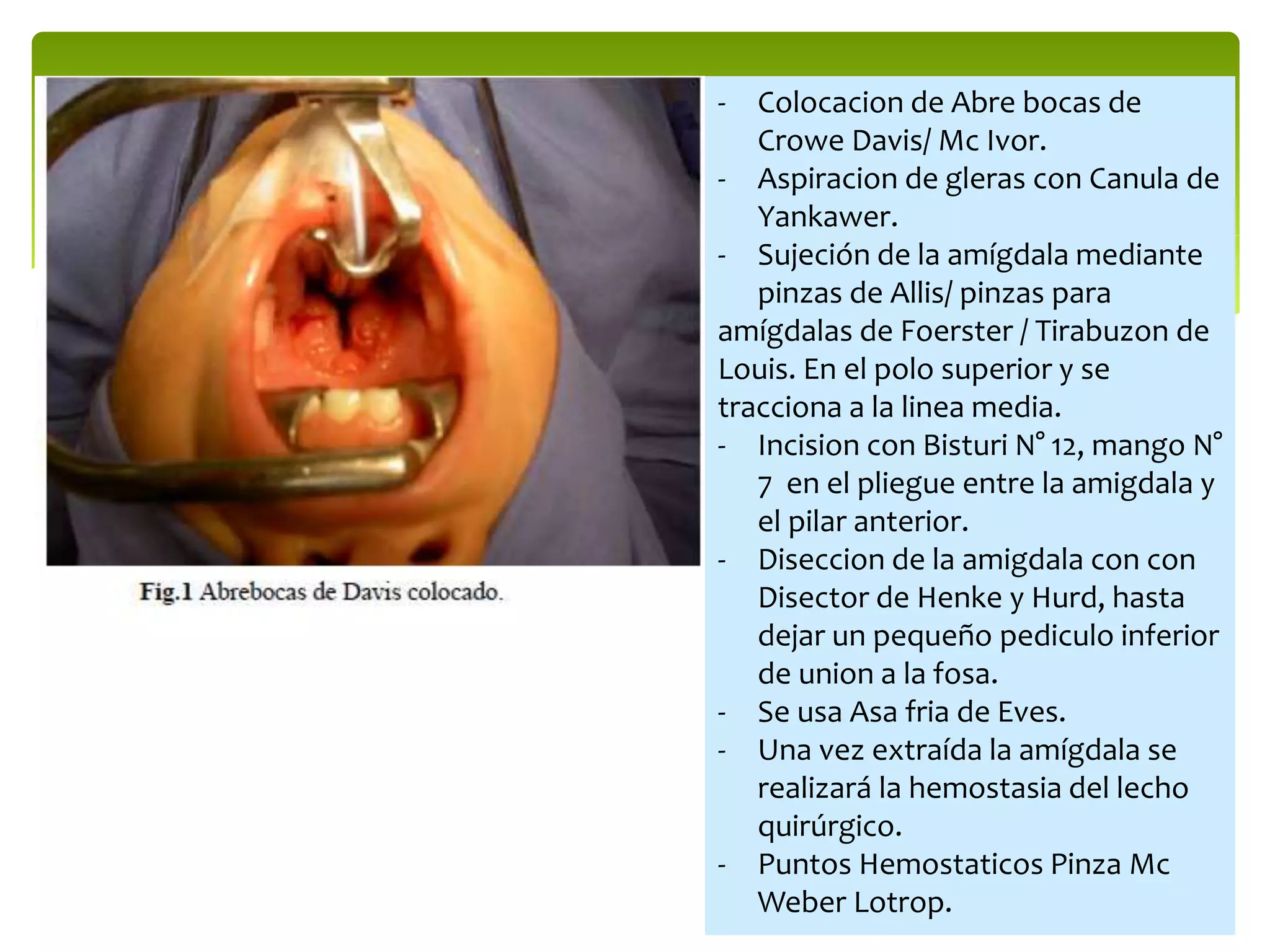 AMIGDALECTOMIA Y ADENOIDECTOMIA.pptx