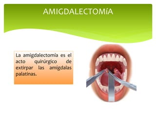 AMIGDALECTOMIA Y ADENOIDECTOMIA.pptx