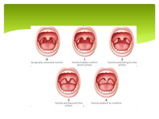 AMIGDALECTOMIA Y ADENOIDECTOMIA.pptx