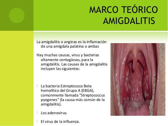 Amigdalitis 120916150215-phpapp02