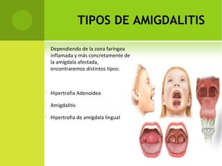 Amigdalitis | PPT