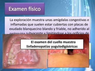 Amigdalitis | PPTX