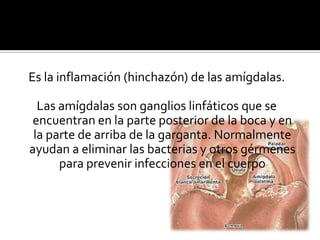 Amigdalitis | PPTX