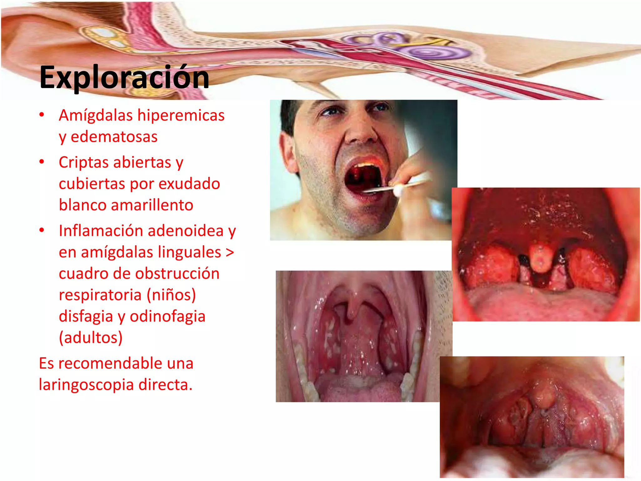 Amigdalitis (bacteriana y viral) (Crónica y Aguda)