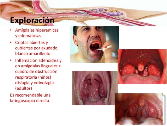 Amigdalitis (bacteriana y viral) (Crónica y Aguda)