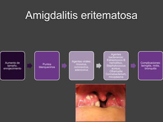 Amigdalitis | PPTX
