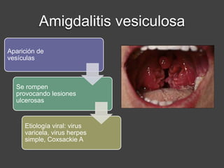 Amigdalitis | PPTX