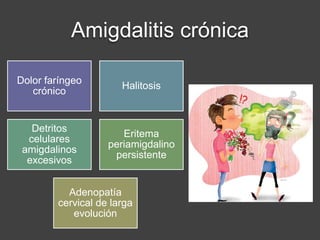 Amigdalitis | PPTX