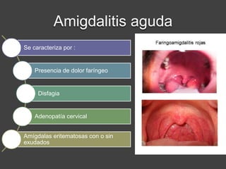 Amigdalitis