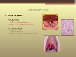 Amigdalitis | PPT