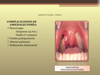 Amigdalitis | PPT