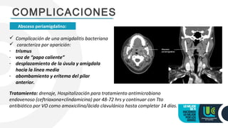 Amigdalitis | PPT
