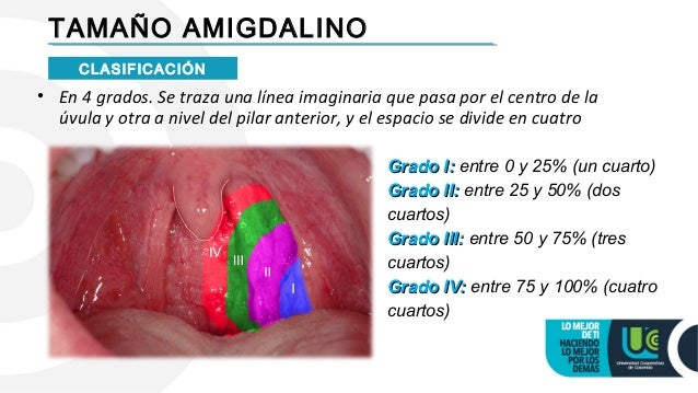 Amigdalitis