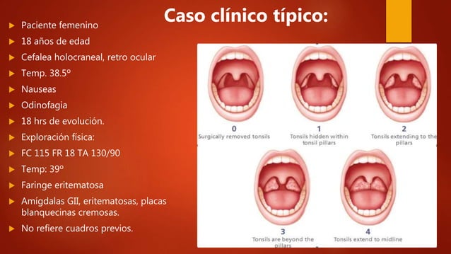 Tipos de Amigdalitis