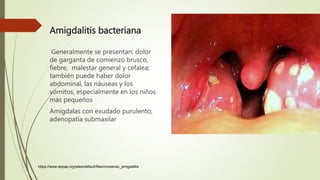 amigdalitis.pptx