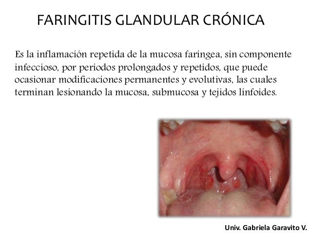 AMIGDALITIS CRONICA UNIVERSIDAD DEL ZULIA