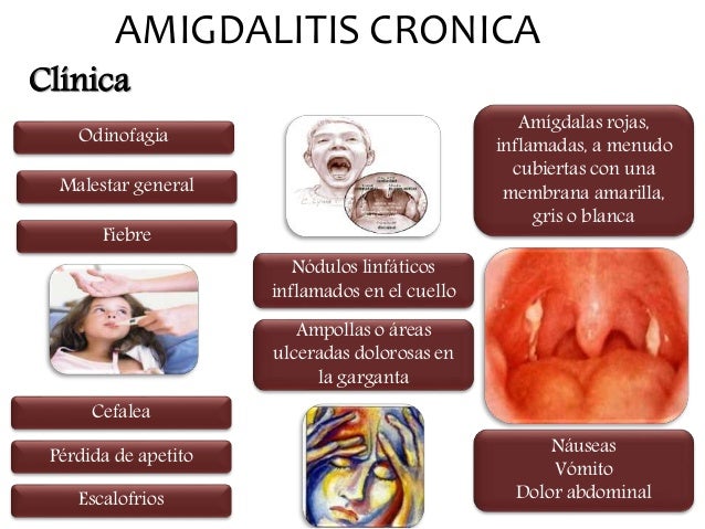 AMIGDALITIS CRONICA UNIVERSIDAD DEL ZULIA