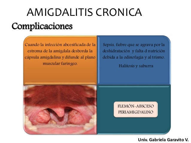 AMIGDALITIS CRONICA UNIVERSIDAD DEL ZULIA