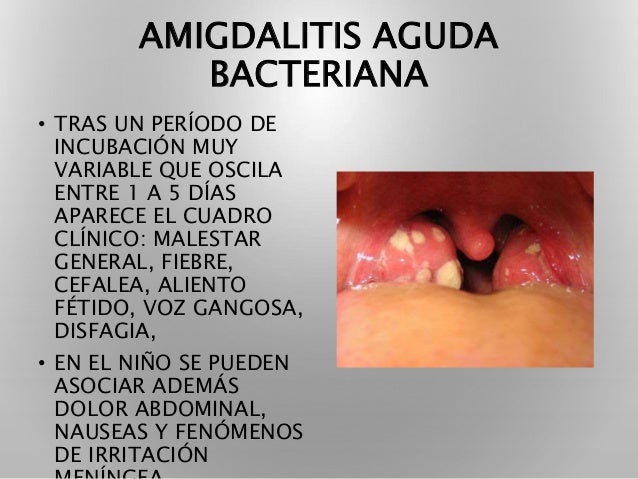 Amigdalitis aguda