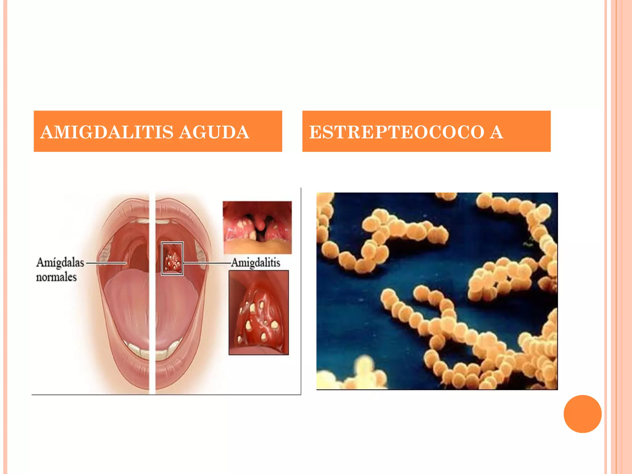 Amigdalitis aguda | PPT | Descarga Gratuita