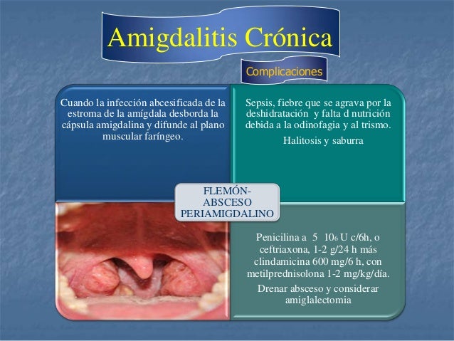 Amigdalitis crónica